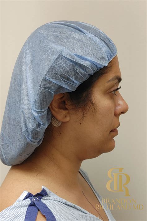 Liposuction Before And After Patient 33 Dr Brandon Richland