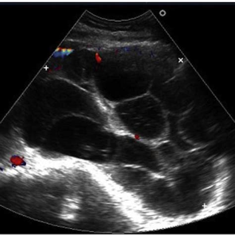 Pdf Hyperreactio Luteinalis Mimicking Malignancy During Pregnancy With Elevated Ca 125