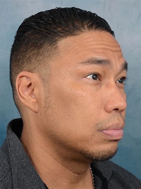 Patient 49861773 Chin Augmentation Before And After Photos Starkman