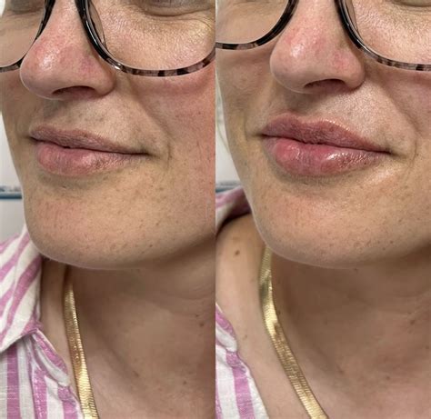Pin By Newcastle Cosmetic Doctor On Lip Filler Lip Fillers Facial