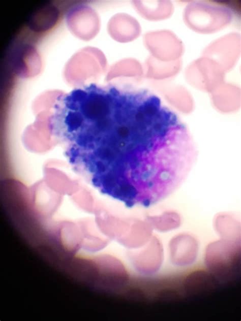 Hemosiderin Laden Macrophage By Sciencelover5 On Deviantart