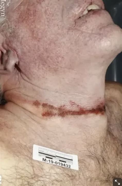 Epstein A Forensic Assessment Of Autopsy Photo Of Epsteins Ligature Marks