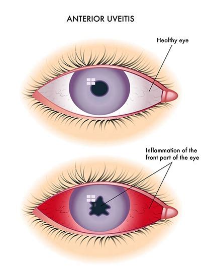 Iritis Vs Conjunctivitis