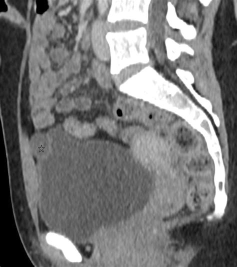 Types Of Congenital Urachal Remnant Radiology Archive