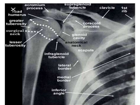 1 Upper Limb Radiograph Presentationpptx