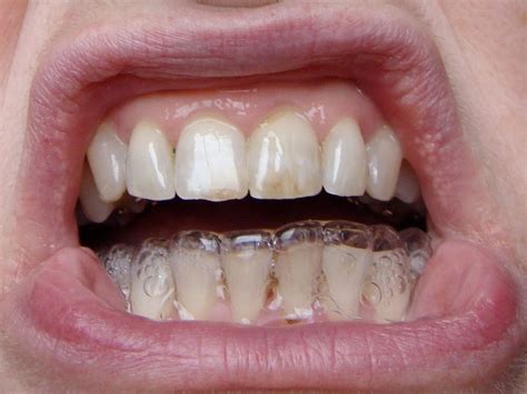 Banded Retainer