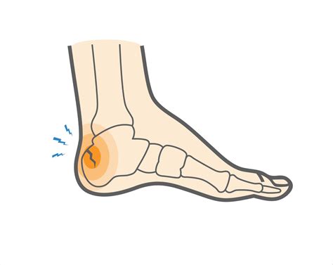 What Is A Calcaneal Stress Fracture And How Do You Recover
