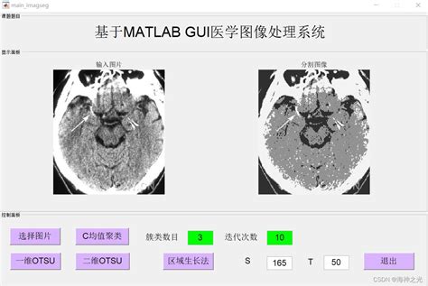 【图像分割】基于matlab Gui医学图像均值聚类oust区域生长法图像分割【含matlab源码 2210期】基于matlab的医学