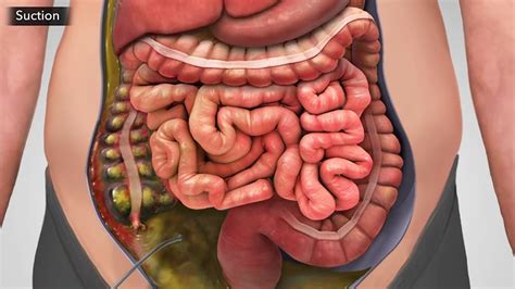 Medical Animation High Impact® Visual Litigation Strategies™