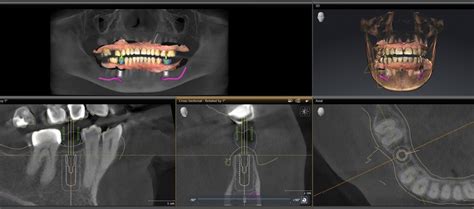 Digitally Guided Implant Placement By Dr Dee Dee Meevasin Dentaltown