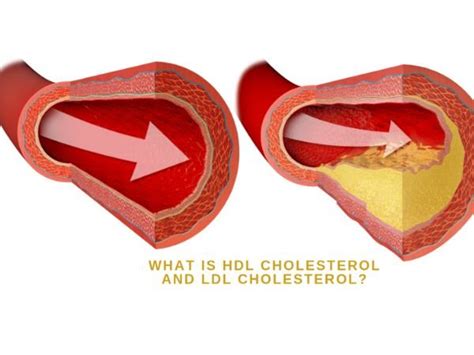 High Triglycerides Hidden Risk For Heart And Diabetes Mdlines