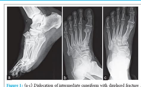 Figure 1 From Dislocation Intermediate Cuneiform With Fracture Medial Cuneiform Semantic Scholar