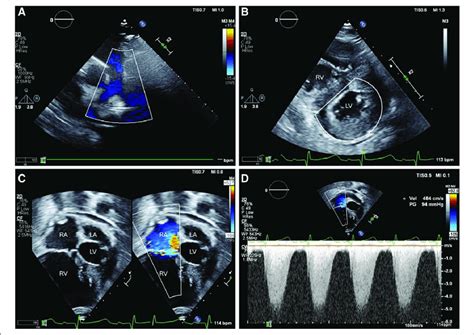 Transthoracic Echocardiogram During And 48 Hr Following Extracorporeal Download Scientific