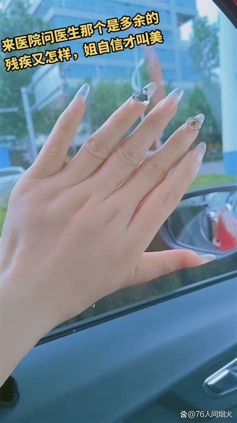 竟然有这样漂亮的六指，如果六根手指是这个形状应该不用动手术了吧。
