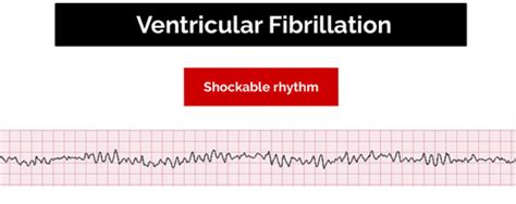 Shockable Vs Non Shockable Rhythms Flashcards Quizlet