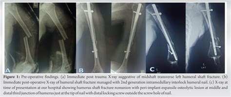Windshield Wiper Effect In Human Bone Peri Implant Benign Diaphyseal Expansile Lesion With