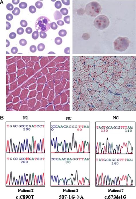 Neutral Lipid Accumulation And Mutations In The Cgi 58 Gene In Cds