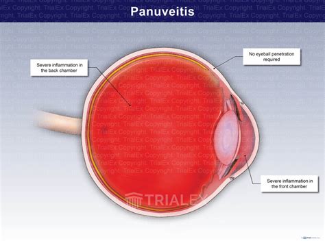 Panuveitis Trialquest Inc