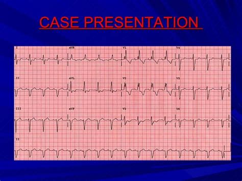 Ecg Rbbb With Lafb Ppt