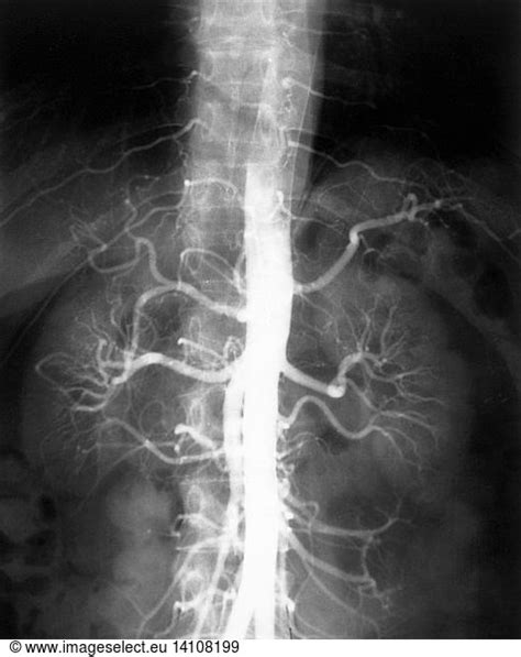 Aortic Arch Arteriogram Aortic Arch Arteriogram Angiogram Angiograph