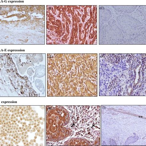 Representative Immunohistochimical Staining Of Hla‐g Hla‐e And Ido Download Scientific