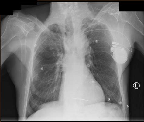 Radiopaedia Case Pacemaker Hematoma Id 49685 Study 54899 Nc Commons