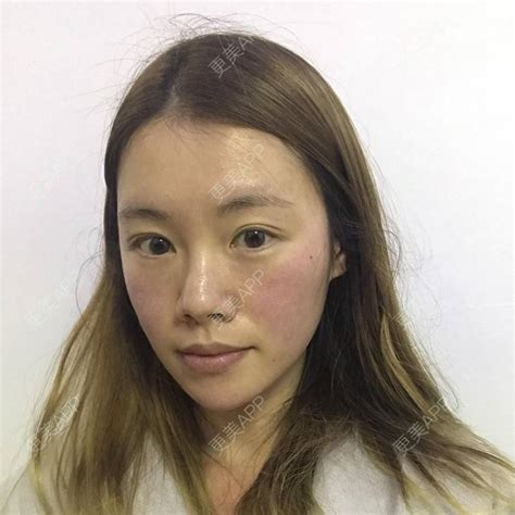 埋线提升前后对比照更美用户wipzdrvt0j埋线提升前后对比照术后219天更美