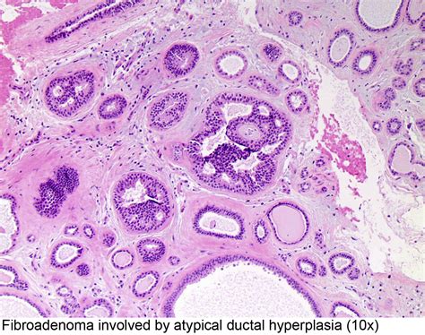 Icd 10 Fibroadenoma Mammae Fibroadenoma Breast Pathology Made