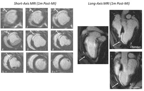 Perspective On The Development Of A Bioengineered Patch To Treat Heart Failure Rationale And