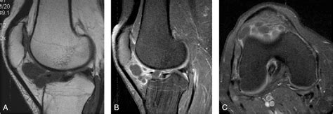 Figure 1 From Magnetic Resonance Imaging Comparison Of Intra Articular