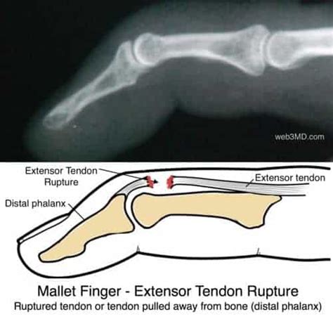 Mallet Finger New