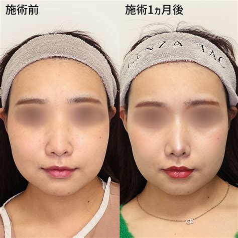 長年のお悩みをスッキリ改善！！バランスのとれたお顔のポイントはお鼻のかたち。｜症例写真・ビフォーアフター｜美容整形･美容外科のtaクリニックグループ
