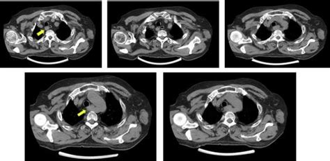 Axial Without Contrast Enhanced Computed Tomography Ct Image Shown A