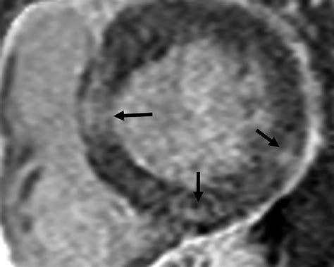 Radiological Detection Of Cardiac Amyloid Mri With Pathological
