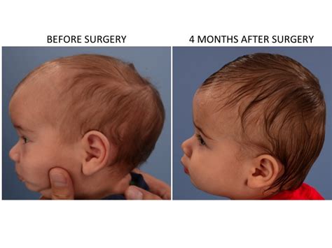 Sagittal Suture Craniosynostosis About Non Syndromic Craniosynostosis