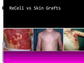 Burns Before And After Pptx