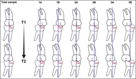 Factors Influencing Molar Relationship Behavior In The Mixed Dentition
