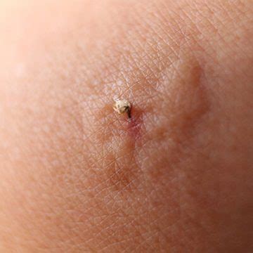 Wasp Vs Bee Sting