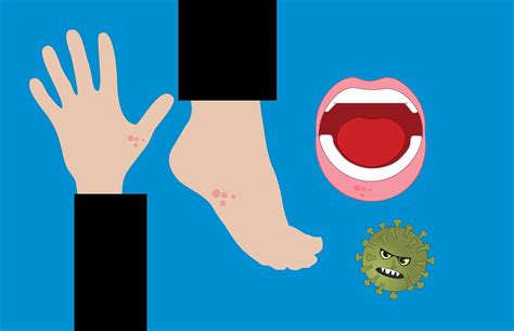 Download Disease Hand Foot Royalty Free Stock Illustration Image
