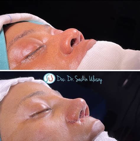 Alar Base Surgery Alarplasty Best Price And Hospitals In Turkey
