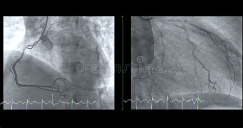 Cardiac Catheterization On Rca And Lad Can Help Doctor Diagnose And Treat Problems In Your Heart