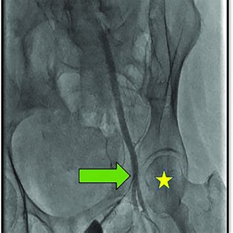 A Ipsilateral Bypass Circuit Showing The Side Arm Of The Large Bore Download Scientific