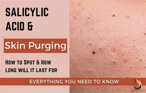 How To Moisturize When Using Tretinoin What To Do And Use Sasily Skin
