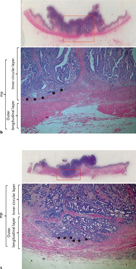 Figure 2 From Analysis Of Lymph Node Metastatic Pattern According To