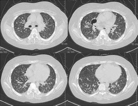 After A 10 Week Treatment Repeated Chest Computed Tomography