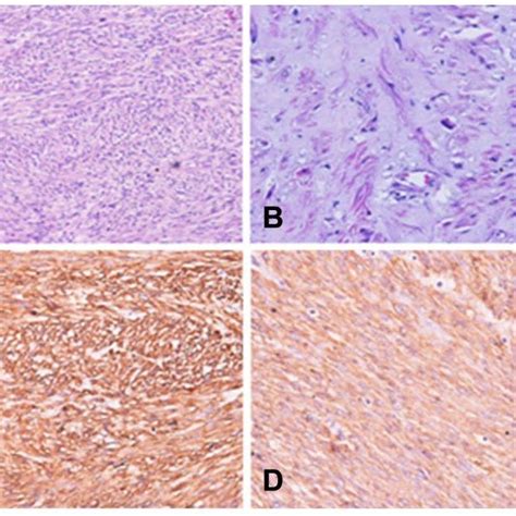 A And B Images Comprising Of Oval To Spindle Tumor Cells Arranged In