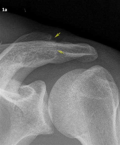 Distal Clavicular Osteolysis In A Bodybuilder Eurorad