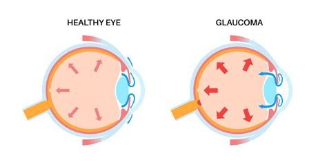 Glaucoma Eye Pressure Royalty Free Vector Image