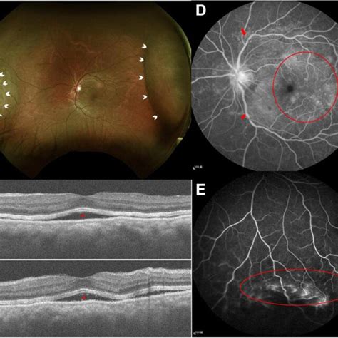 A Color Fundus Photography Demonstrated Serous Retinal Detachment At Download Scientific
