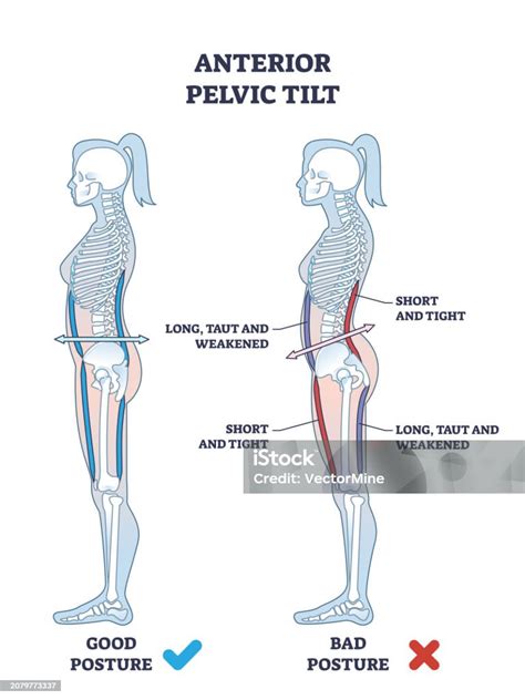 Anterior Pelvic Tilt Or Apt As Pelvis Abnormal Posture Outline Diagram